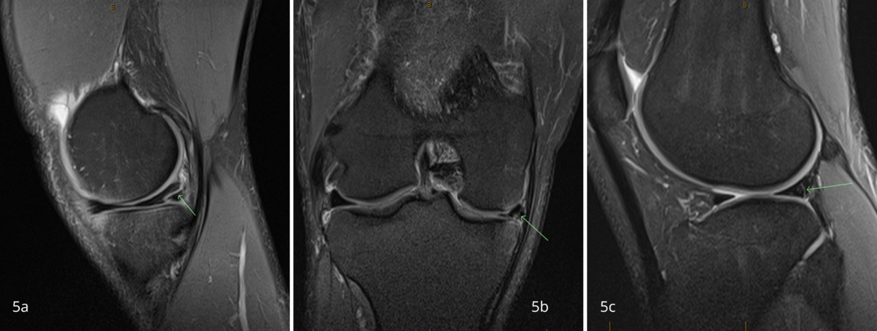 Meniscus Tear | Jiu-Jitsu Medicine